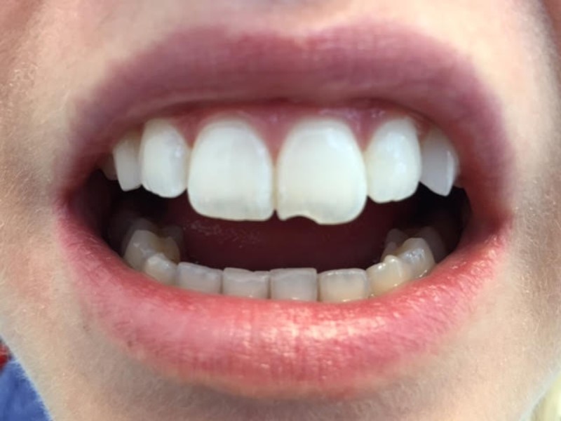 Repairing Children's Broken Tooth - Dr.Fatemeh Mobaraki