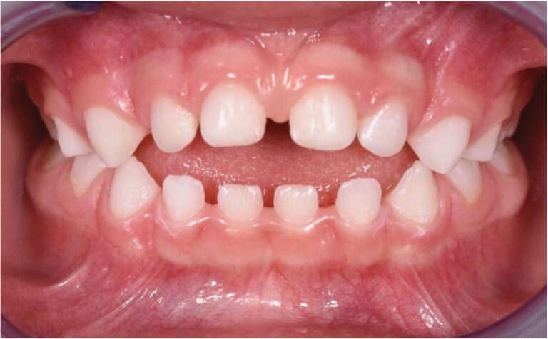 Pacifier Teeth in Children: How to Protect Your Child's Smile - Dr ...