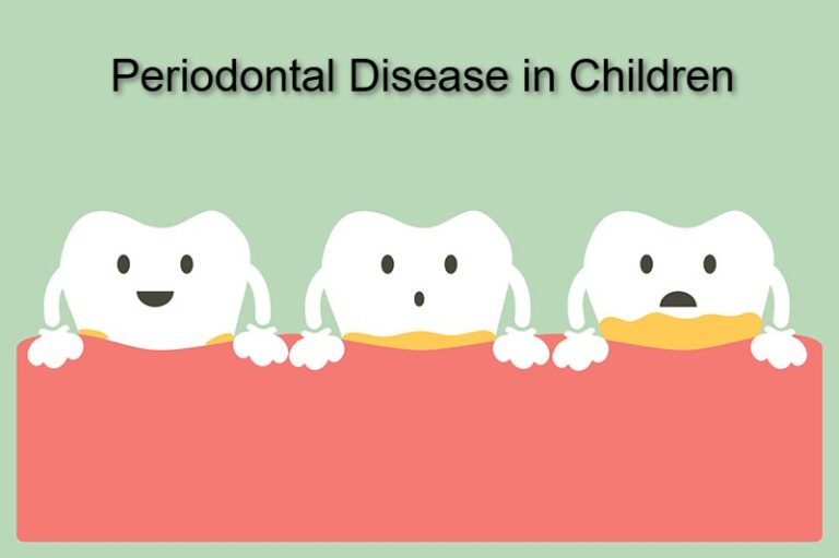 Periodontal Disease in Children - Dr.Fatemeh Mobaraki